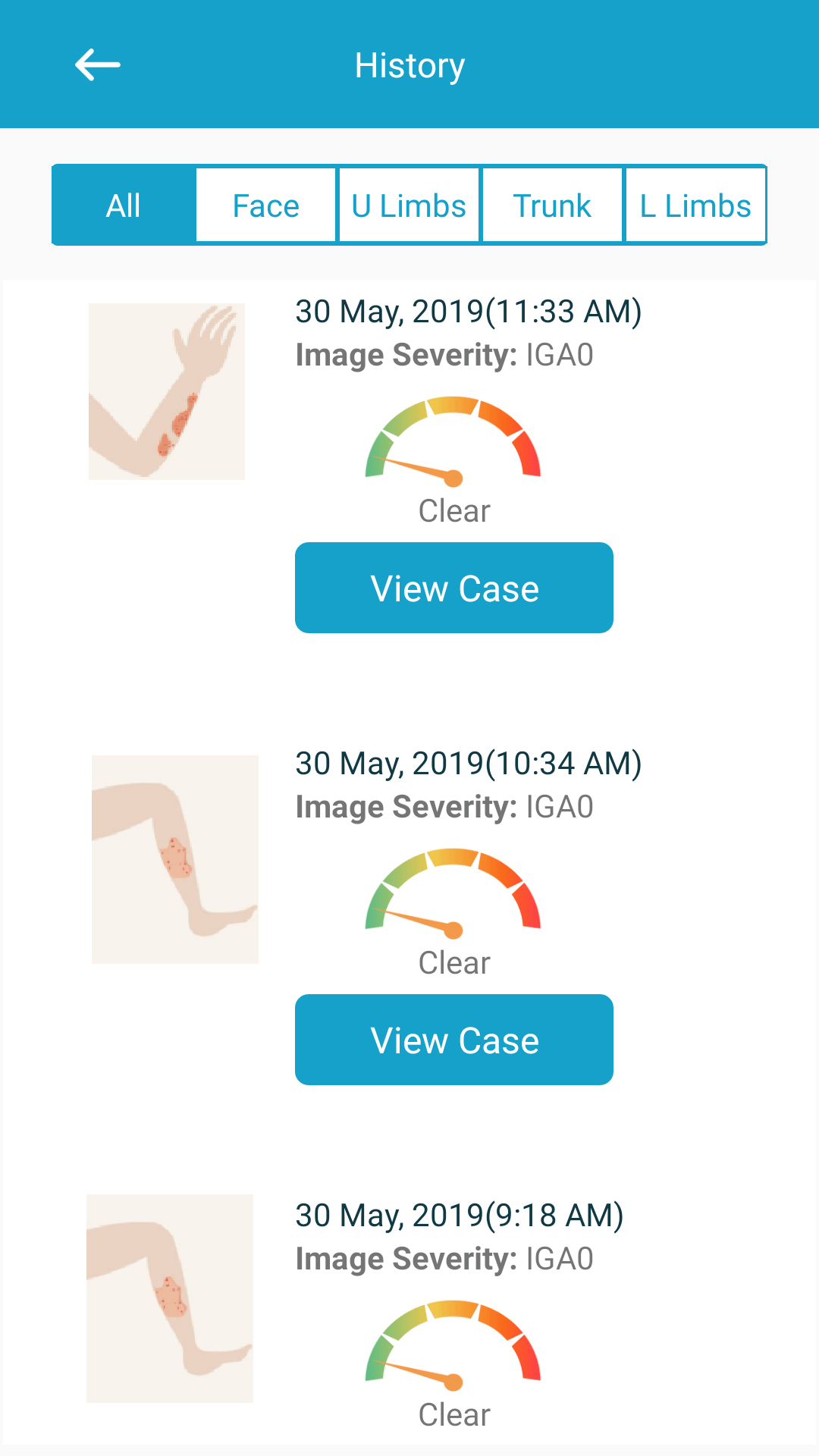 Eczema App, Eczema signs and symptoms, Eczema skin infection