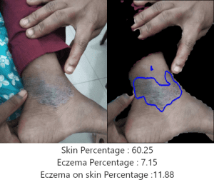 Eczemaless | Body Surface Area Calculation