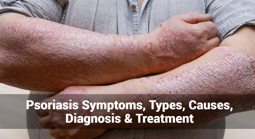 Psoriasis Symptoms, Types, Causes, Diagnosis & Treatment | Eczemaless