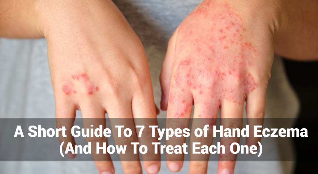 A Short Guide To 7 Types of Hand Eczema (And How To Treat Each One) | Eczemaless