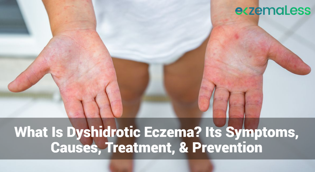 What Is Dyshidrotic Eczema? Its Symptoms, Causes, Treatment, & Prevention | Eczemaless