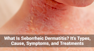 What Is Seborrheic Dermatitis? It’s Types, Cause, Symptoms, and ...