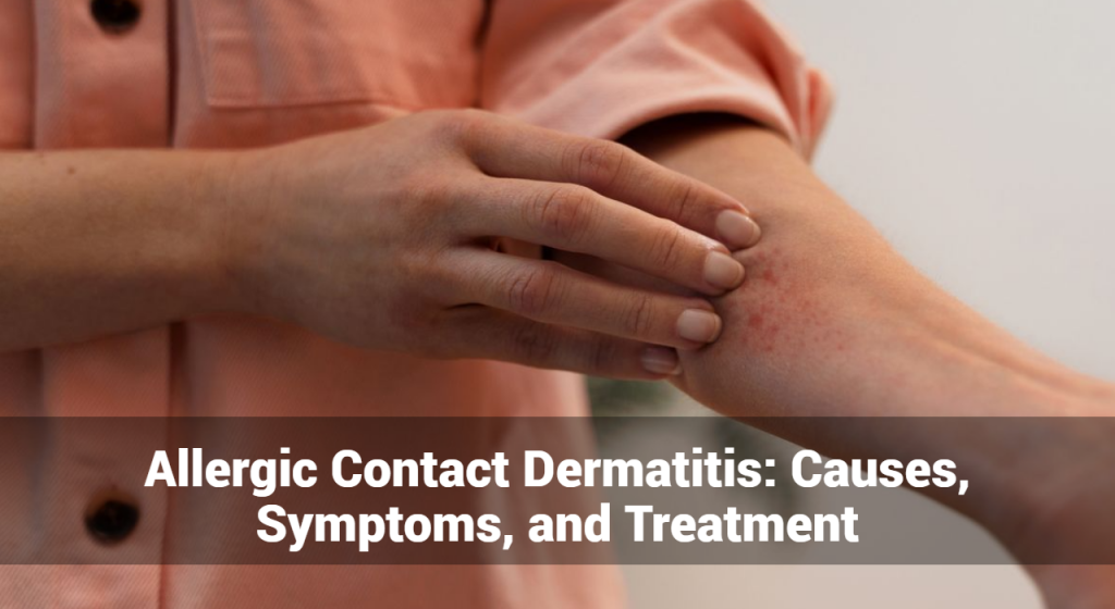 Dermatite allergique de contact : causes, symptômes et traitement ...