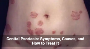 Psoriasis génital : symptômes, causes et comment le traiter | Eczemaless