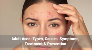 Adult Acne: Types, Causes, Symptoms, Treatment & Prevention | Eczemaless